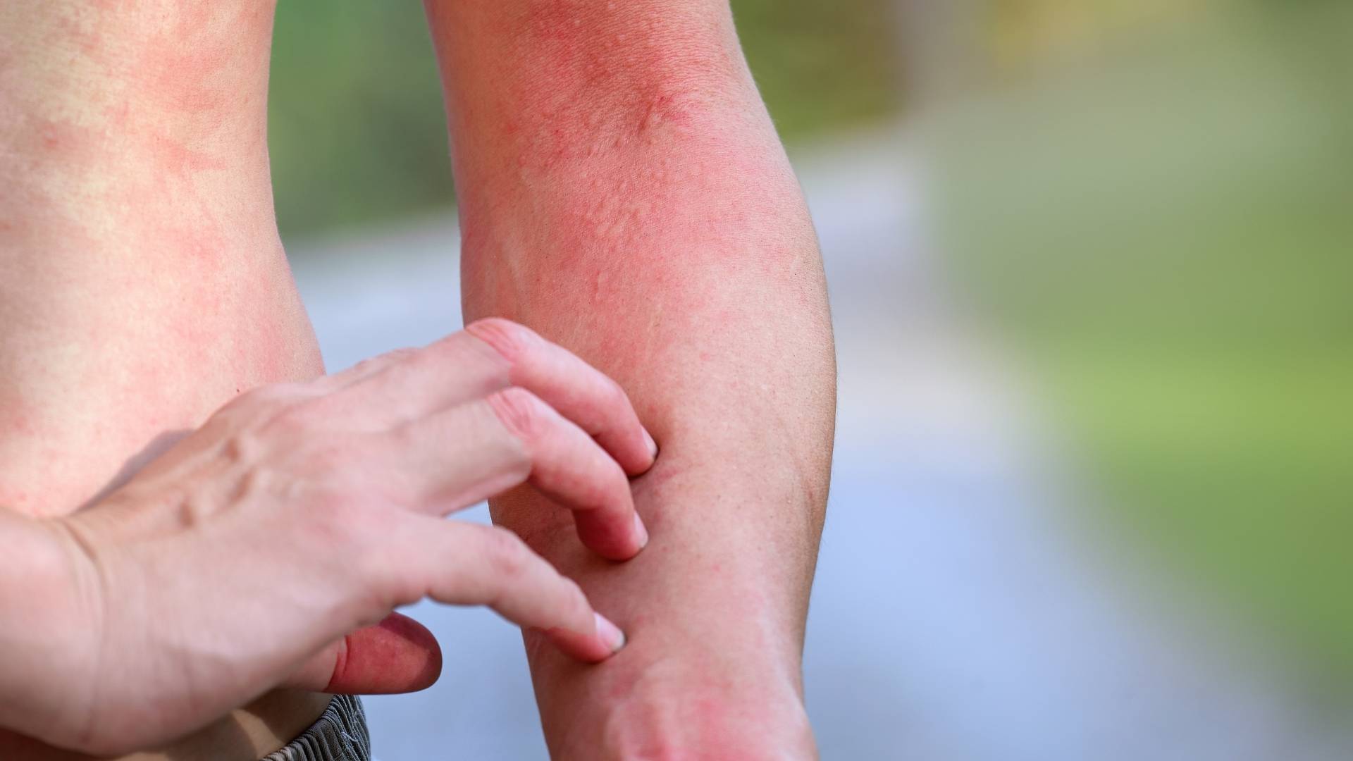 Fungal Rash Misdiagnosis Of Cutaneous Fungal Infections Leads To