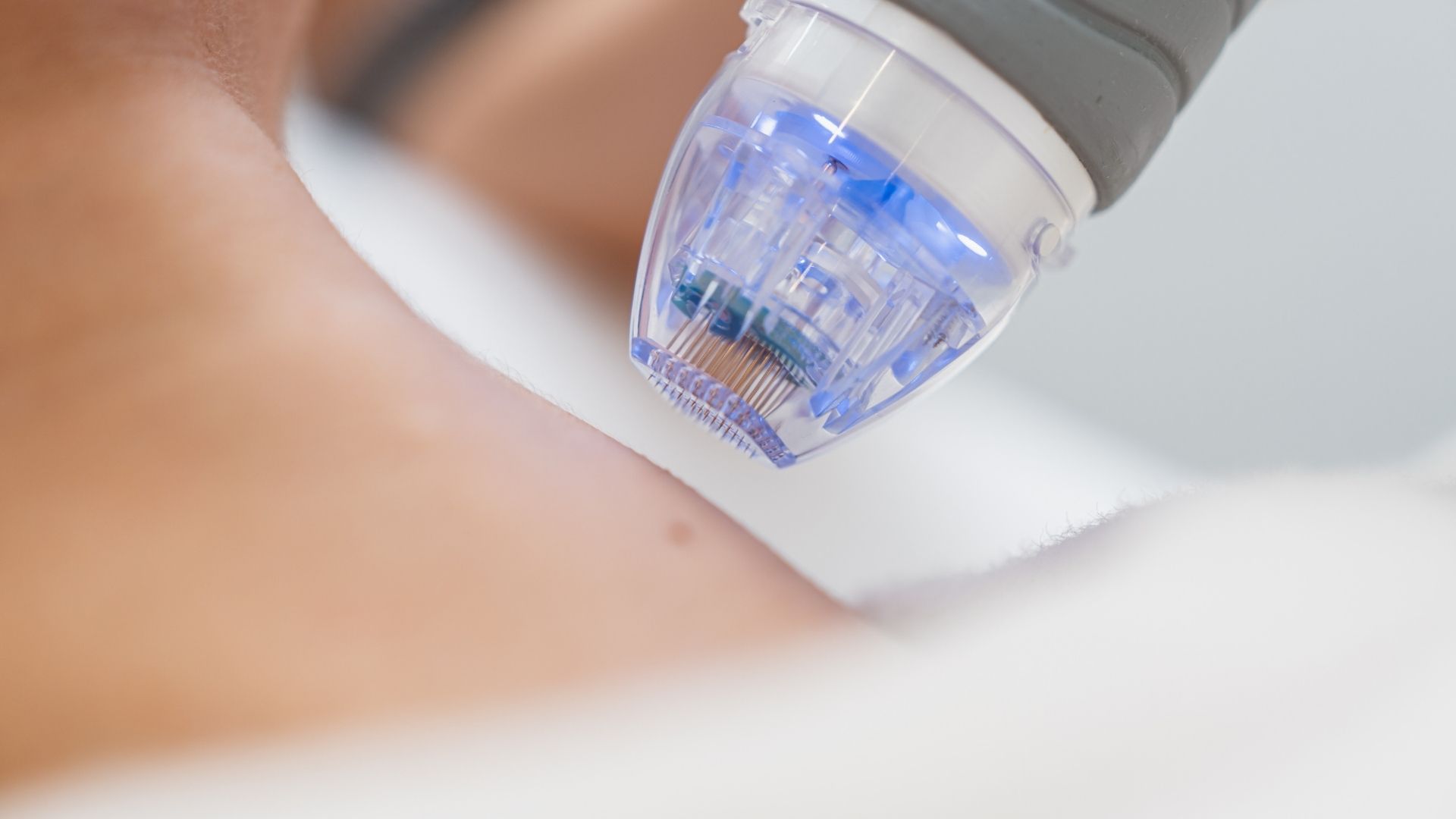 Microneedling with Radio Frequency - Village Dermatology